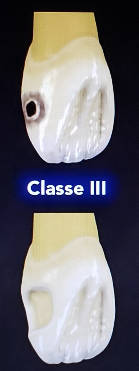 Classificação de Black - Classe III - Dentística