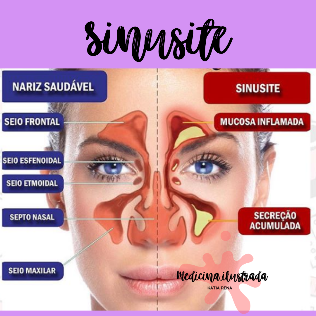 Sinusite - Fisiologia II