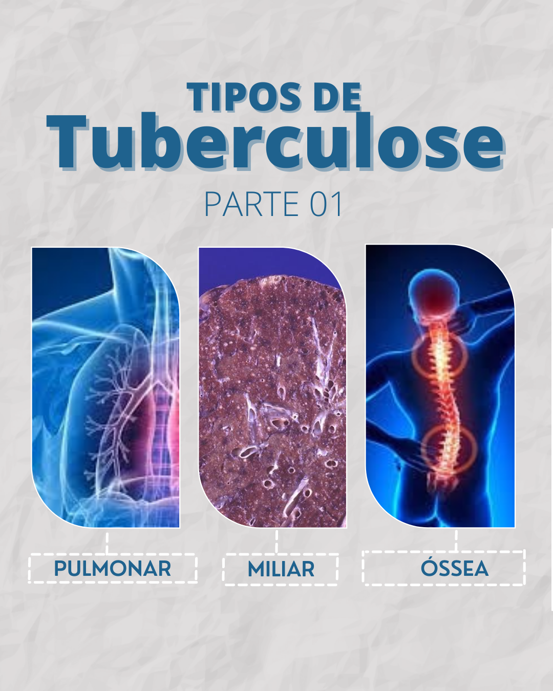 Tuberculose Primaria E Secundaria - RETOEDU
