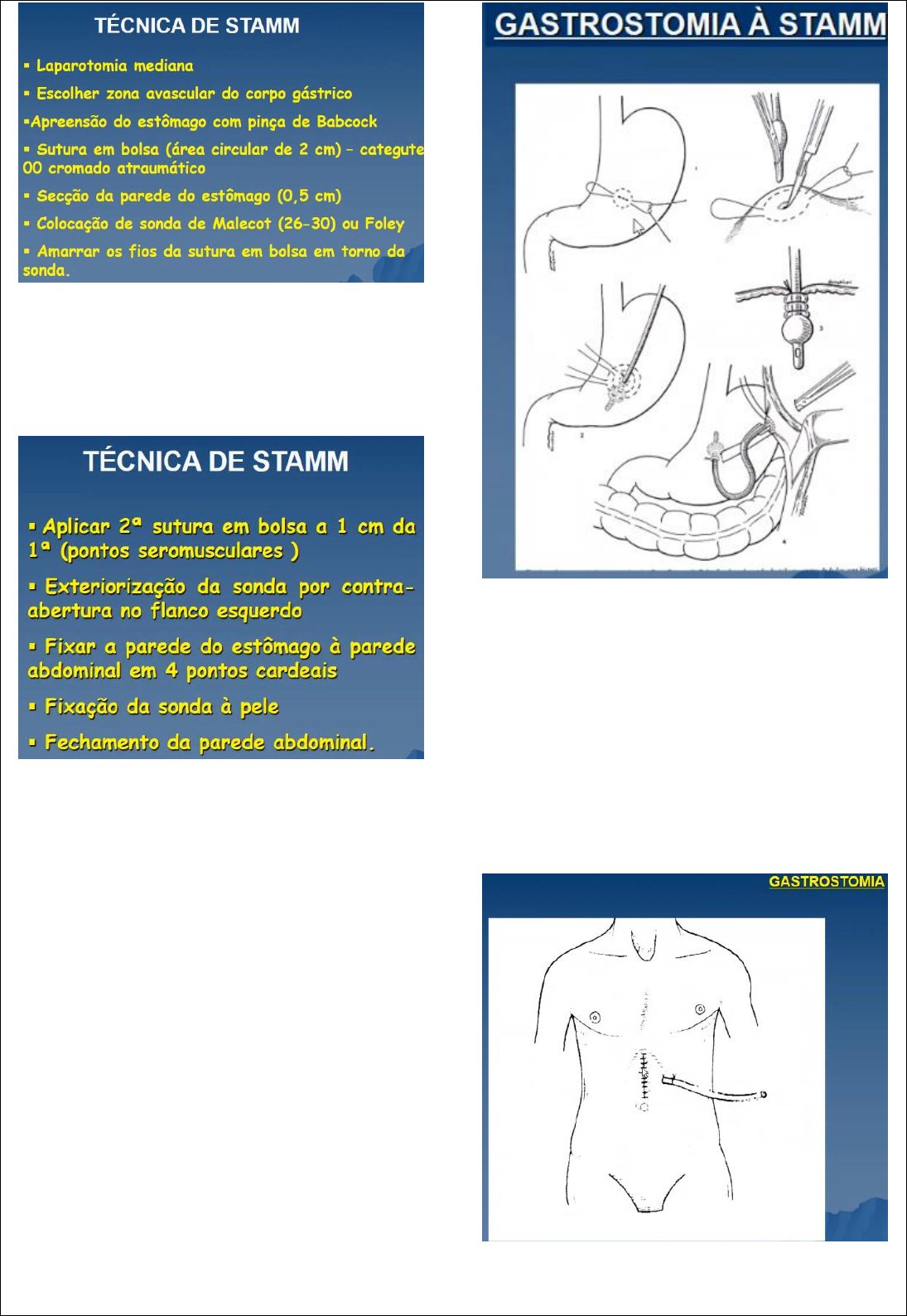 GASTROSTOMIA E JEJUNOSTOMIA Cirurgia, 60% OFF