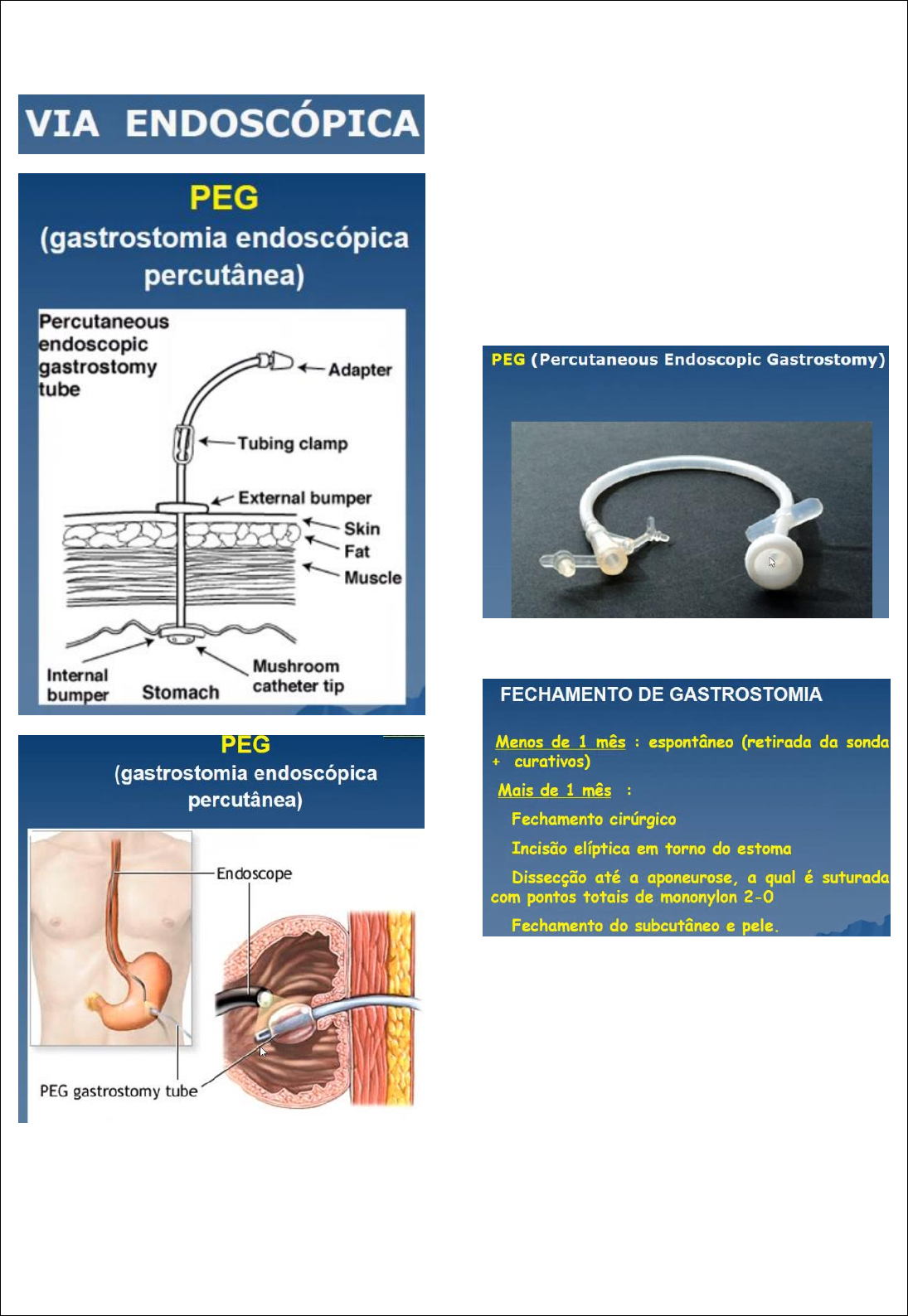 GASTROSTOMIA E JEJUNOSTOMIA Cirurgia, 60% OFF