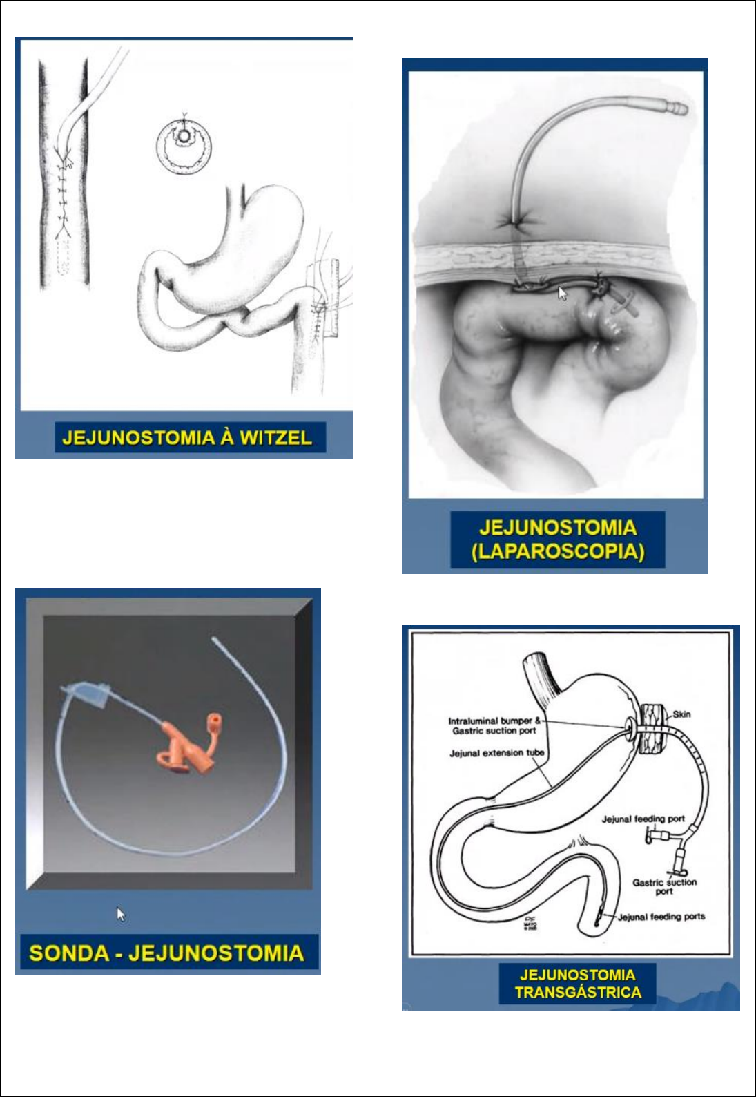 GASTROSTOMIA E JEJUNOSTOMIA Cirurgia, 60% OFF