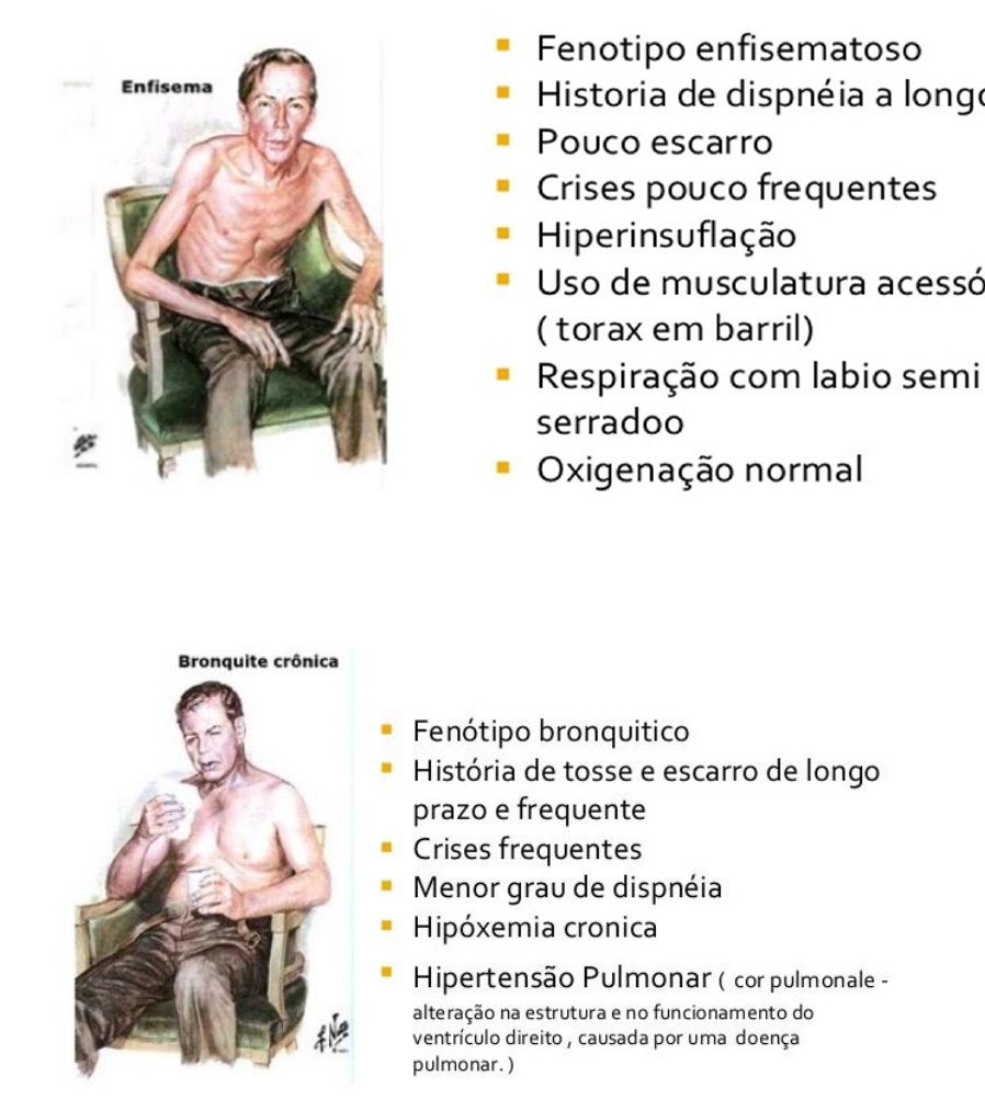 Doença Pulmonar Obstrutiva Crônica - Semio