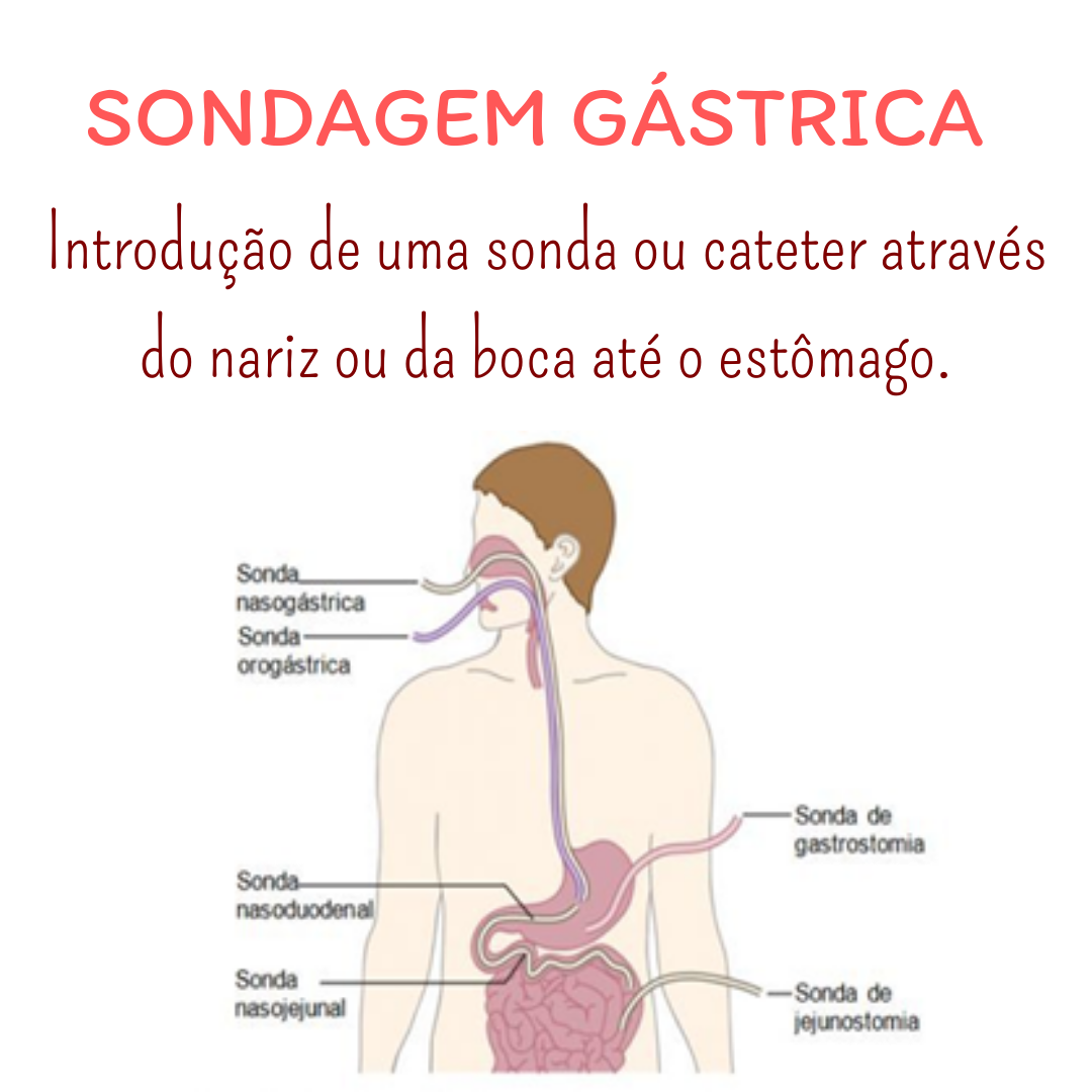 SONDAGEM GÁSTRICA - Enfermagem