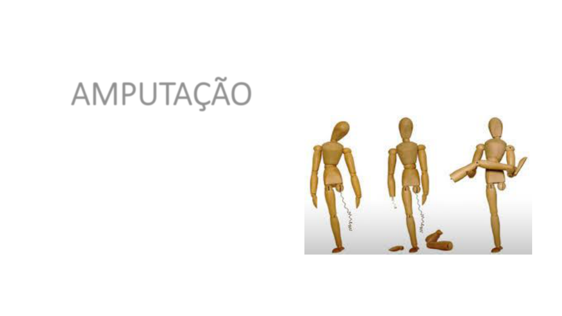 Amputacao Traumatica Ied ReTalho Da ArTéria InTerÓssea PosTerior Na