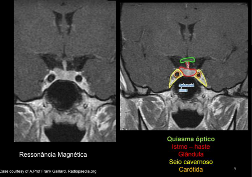 Sela Vazia Ressonancia Magnetica