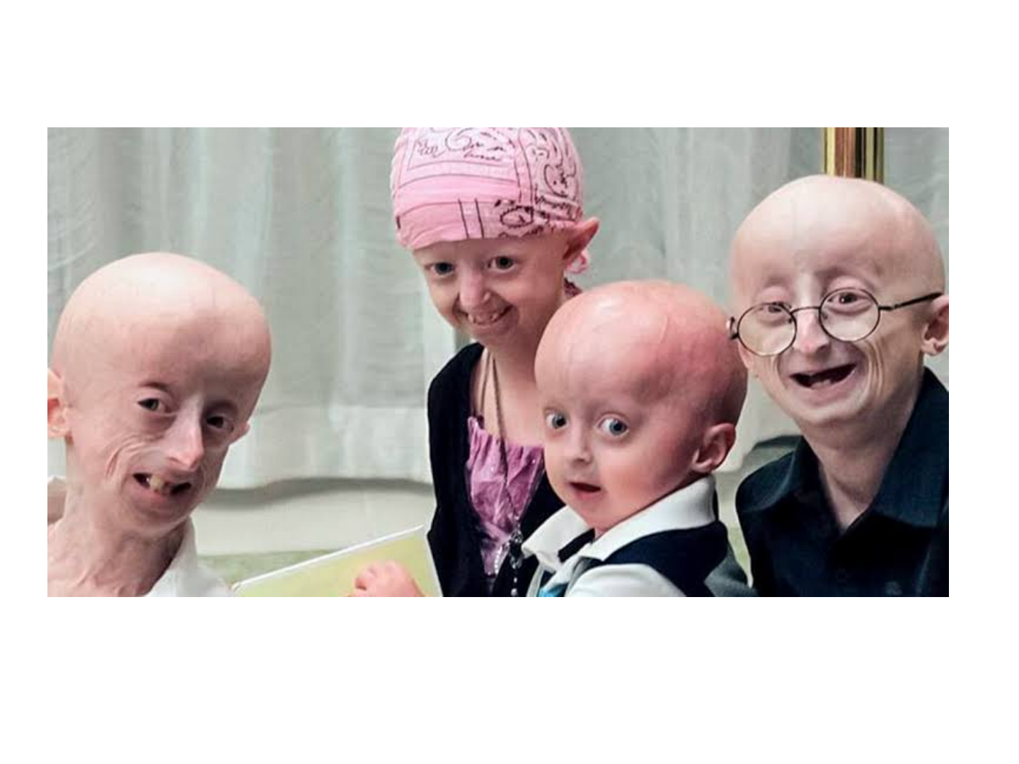 Cromossomo Progeria PRINCIPAIS SÍNDROMES BASEADAS EM EVIDÊNCIAS