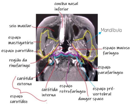 Abscesso Retrofaringeo Em Criancas