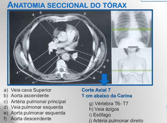 ANATOMIA SECCIONAL DO TÓRAX - Anatomia I