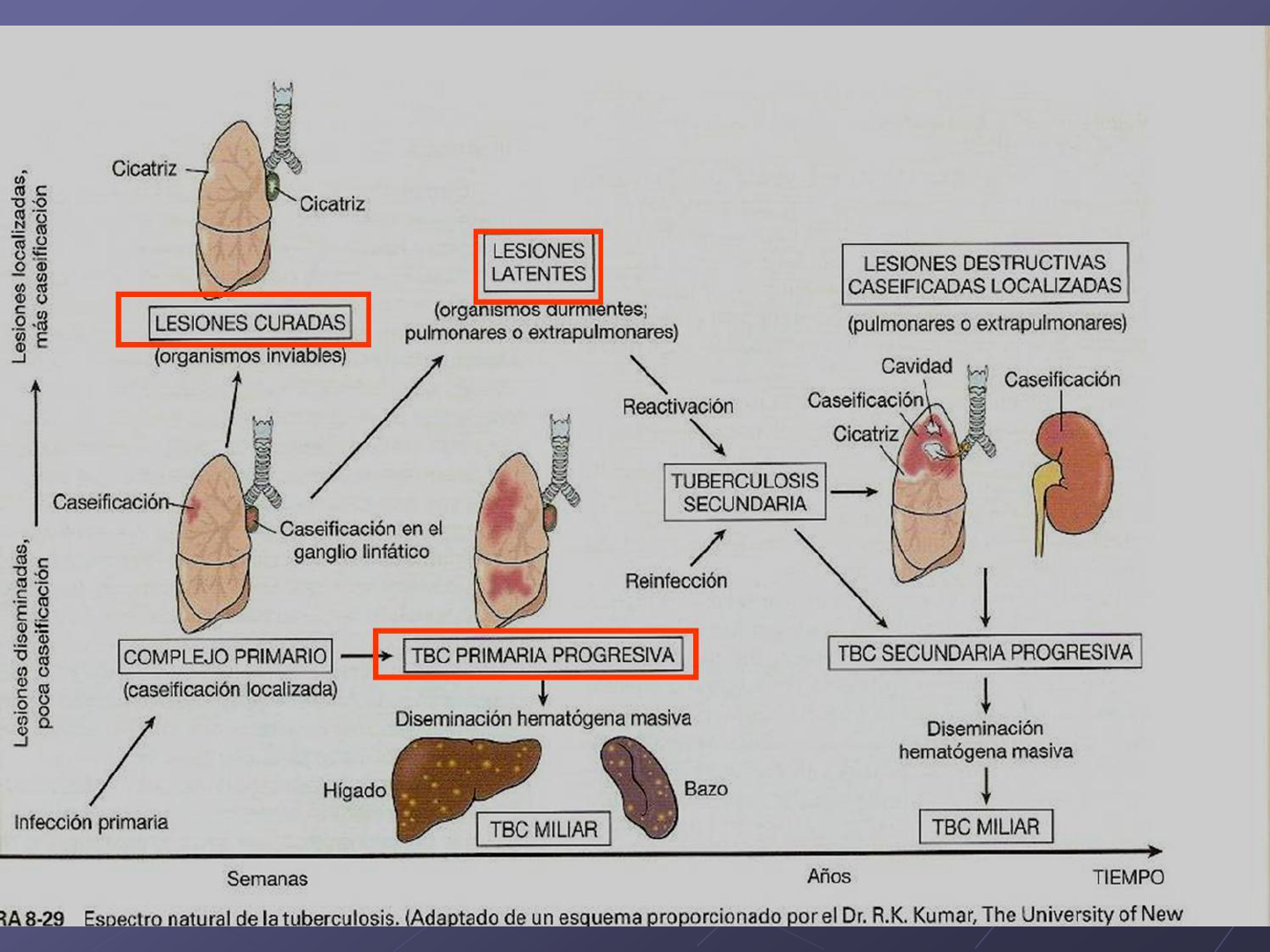AnatoPato Evolucion de Tuberculosis Primaria - Anatopatologia I