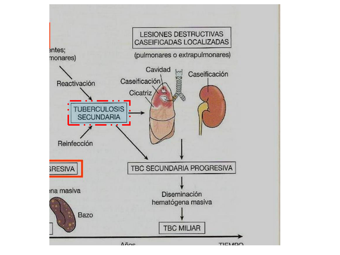 AnatoPato Evolucion de Tuberculosis Primaria - Anatopatologia I