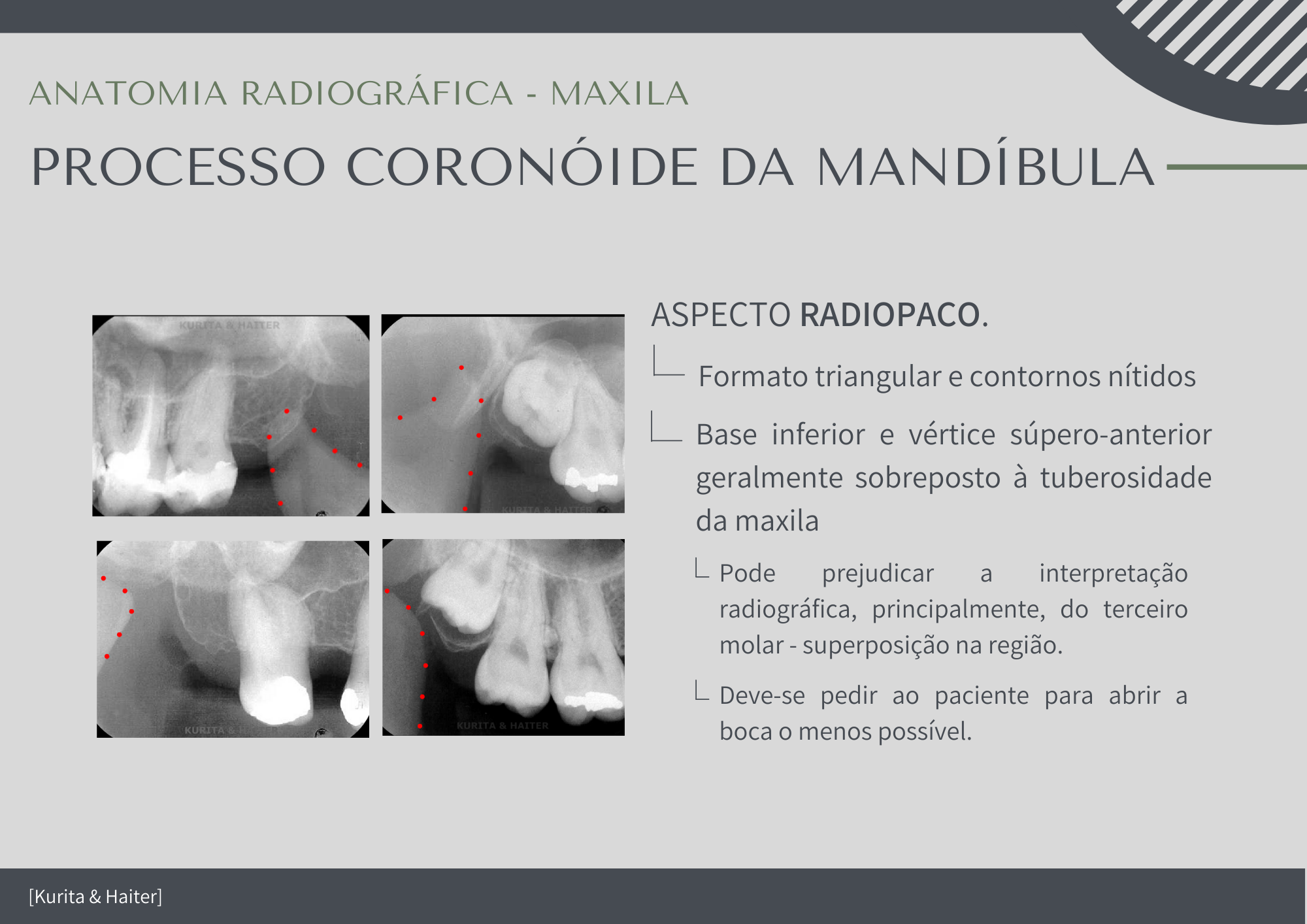 Anatomia Radiográfica - Processo Coronóide da Mandíbula - Radiologia ...