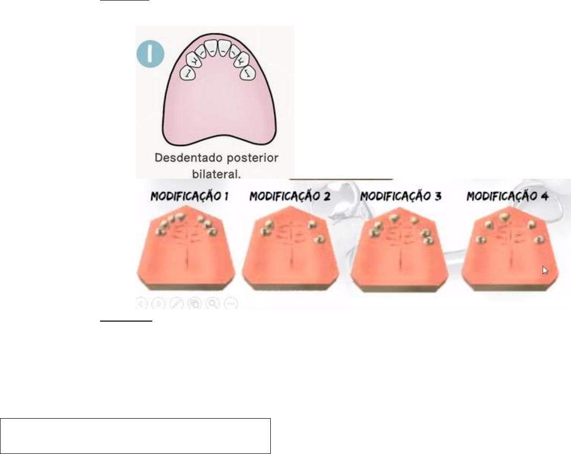 ATUALIZADO - 00 Classificações Kennedy, Applegate e Rumple -Prótese ...