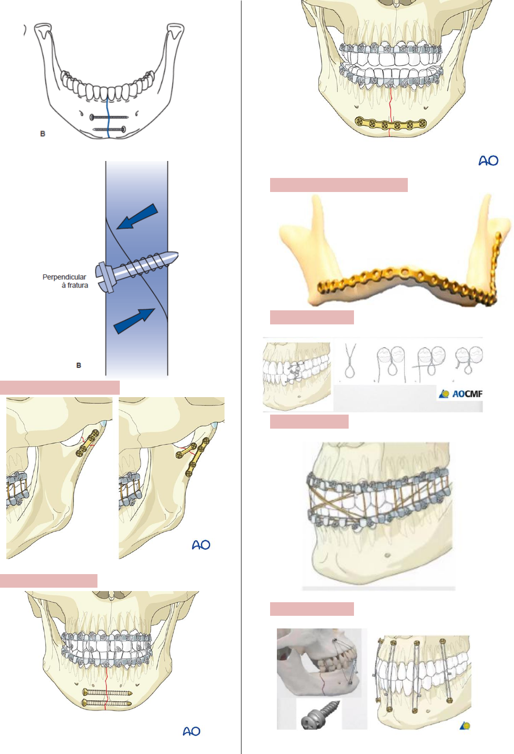 Diagnóstico e tratamento das fraturas mandibulares - Cirurgia e ...