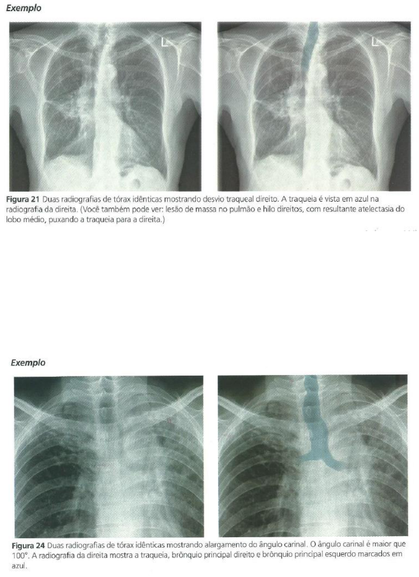 Desvio Traqueal DISA MEDINOTEC – FR Medical
