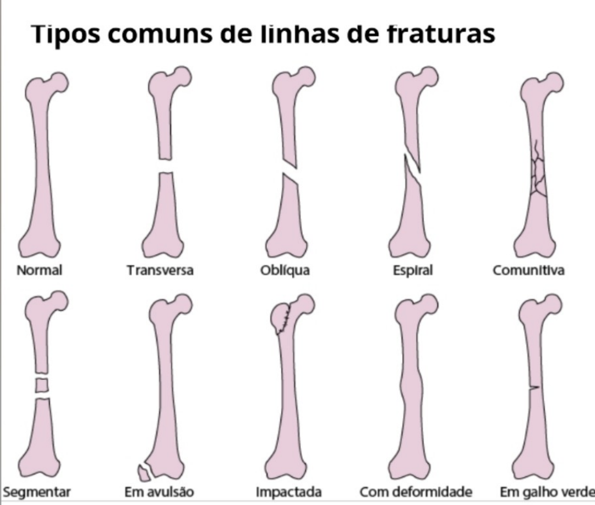 Tipos de fraturas - Fisioterapia Esportiva