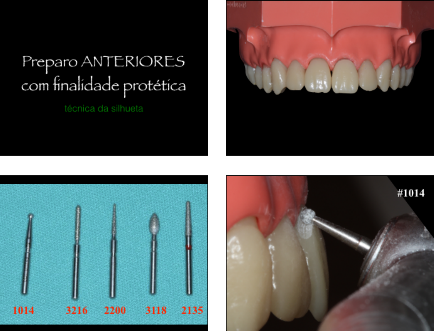 Preparos Protéticos - Odontologia Restauradora
