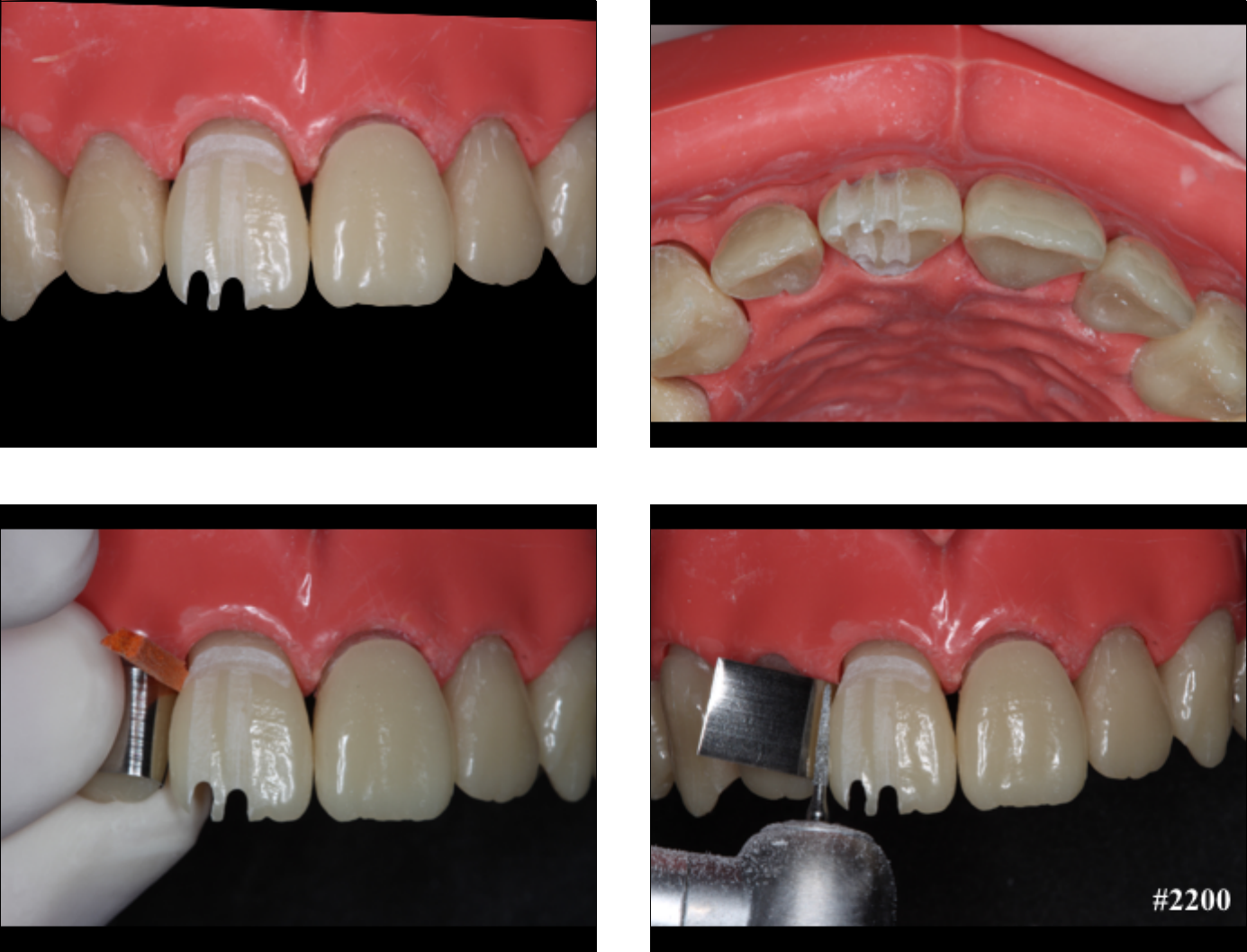 Preparos Protéticos - Odontologia Restauradora