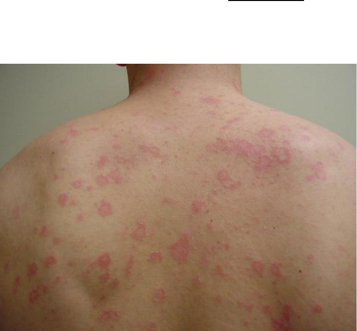 Roseola Sifilitica AEDV Expert Consensus For The Management Of