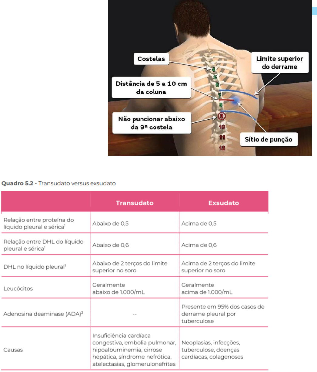 Etapas Do Procedimento De Toracocentese