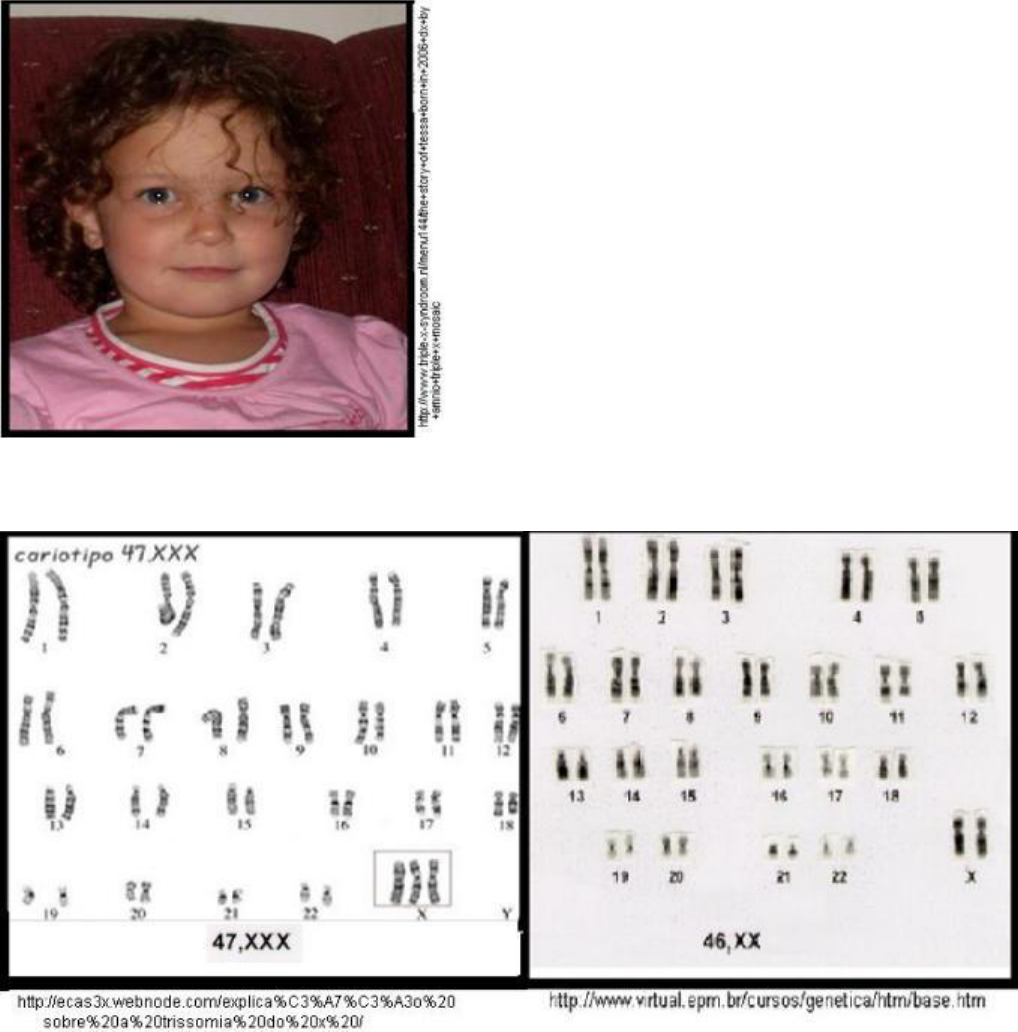 Pessoas Com Sindrome Do Triplo X Síndromes Cromossômicas E Suas