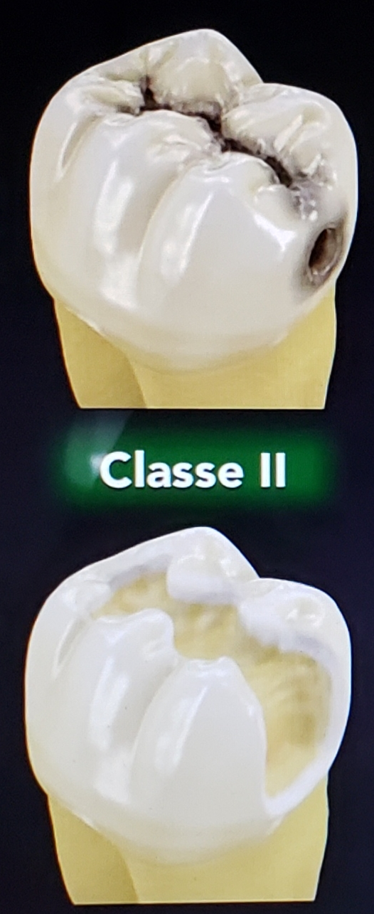 Classificação de Black - Classe II - Dentística