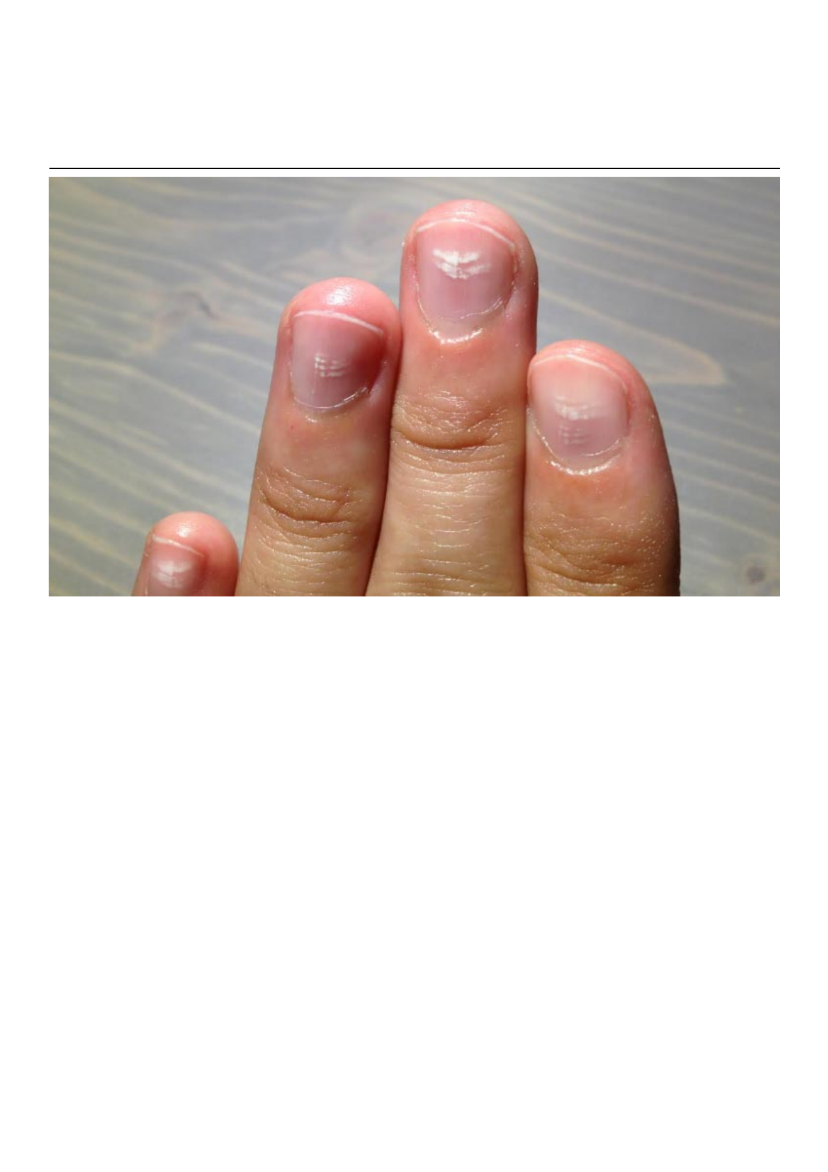Leuconiquia Na Doenca Hepatica Dermatologista Da Unha Dr Thiago
