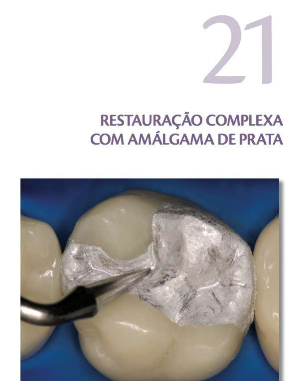 CAPITULO AMALGAMA COMPLEXO - Dentística