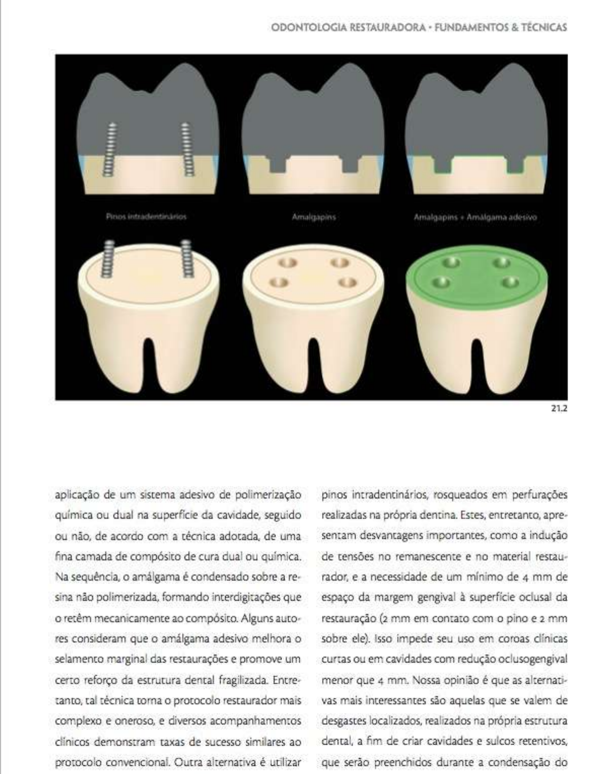 CAPITULO AMALGAMA COMPLEXO - Dentística