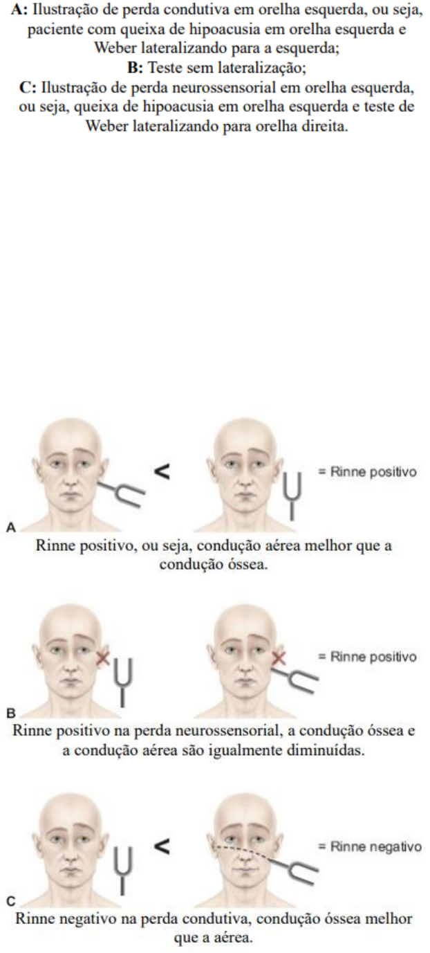 Teste de Rinne e Weber - Causas e Tipos de Surdez, Procedimento e ...