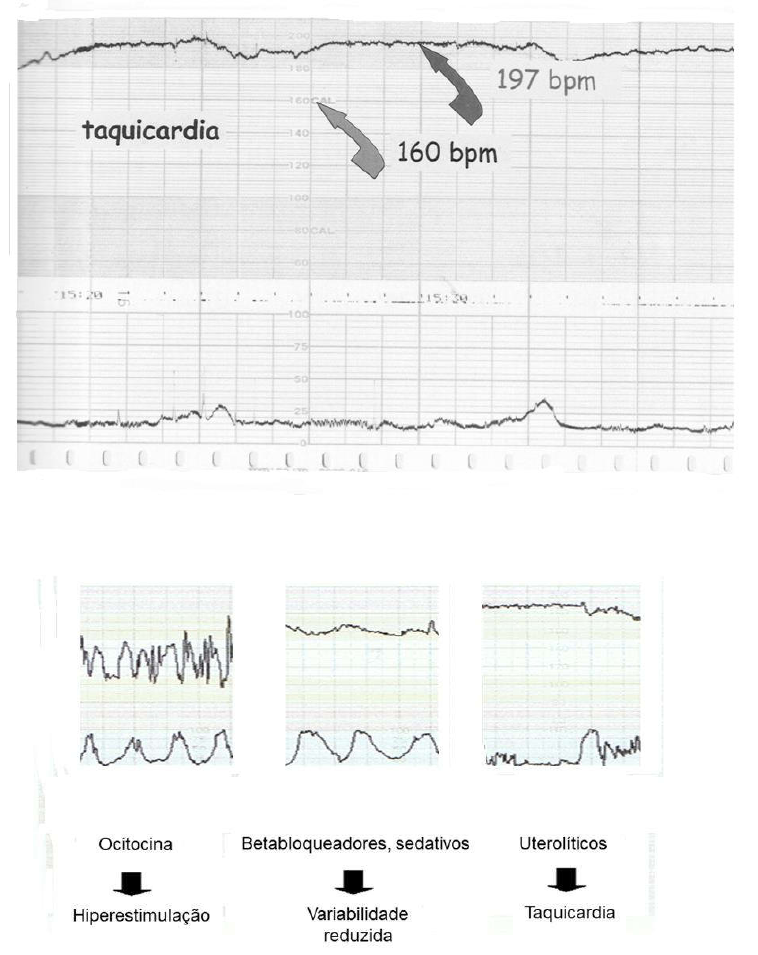 Cardiotocografia - Ginecologia e Obstetrícia