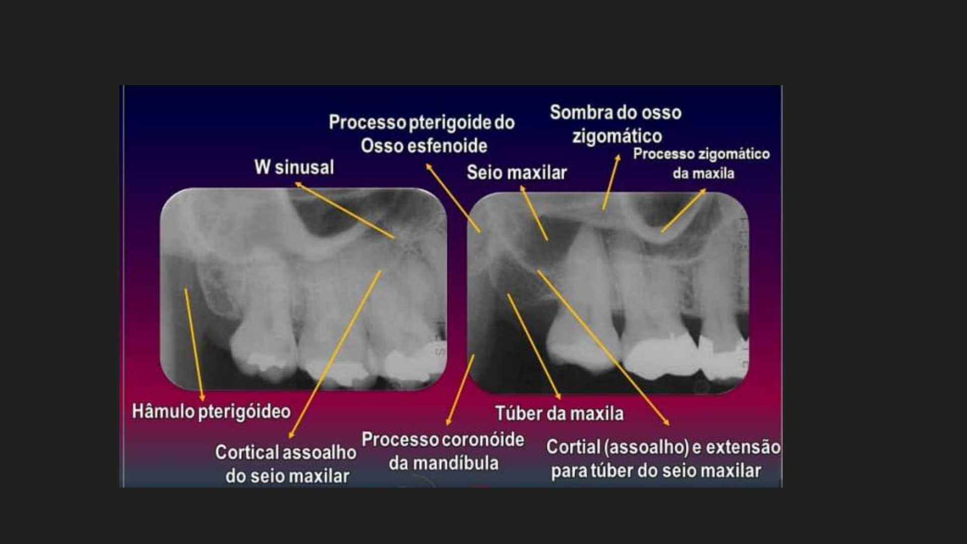 Radiografia Do Processo Zigomatico UniEVANGÉLICA