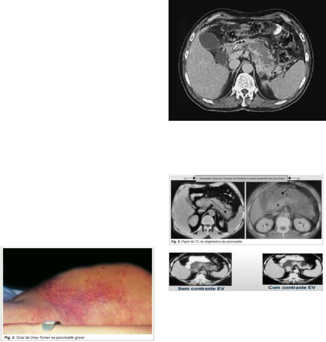 Sinal De Turner Cinza Pancreatite