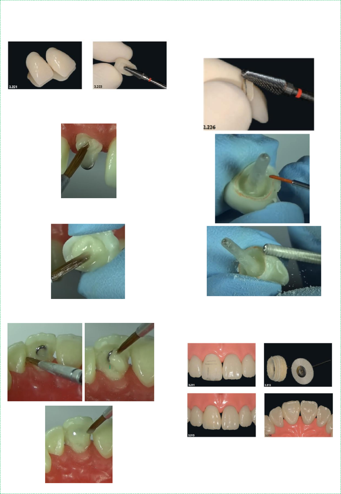 Provisorio intrarradicular com fio de orto - Prótese Fixa