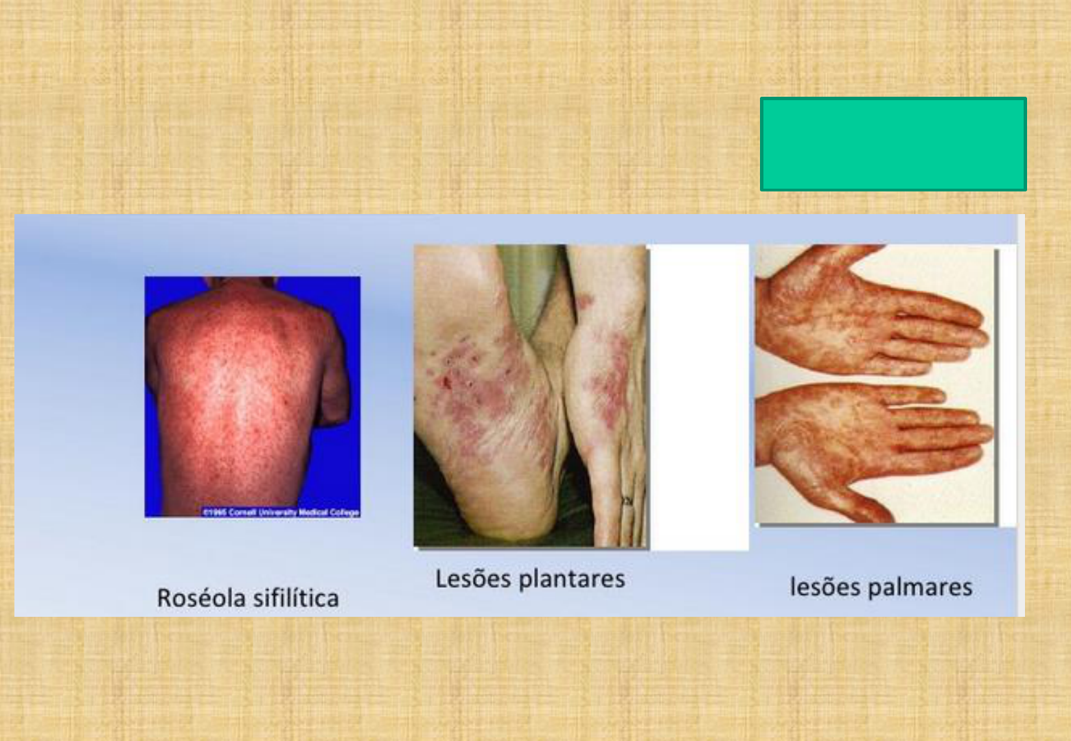 Roseola Sifilitica AEDV Expert Consensus For The Management Of