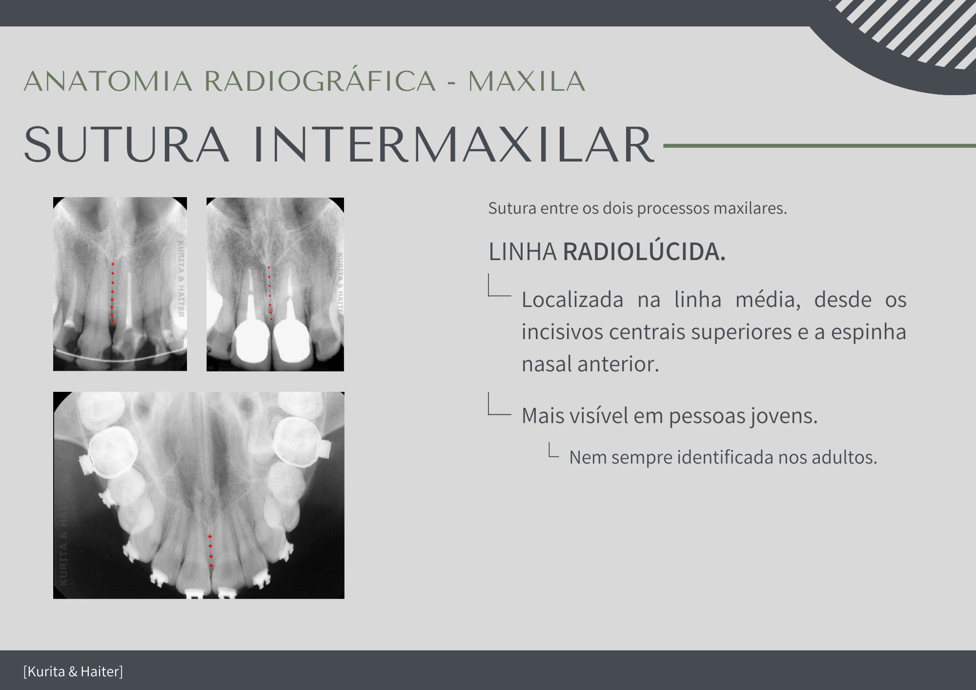 Anatomia Radiográfica - Sutura Intermaxilar - Radiologia Odontológica