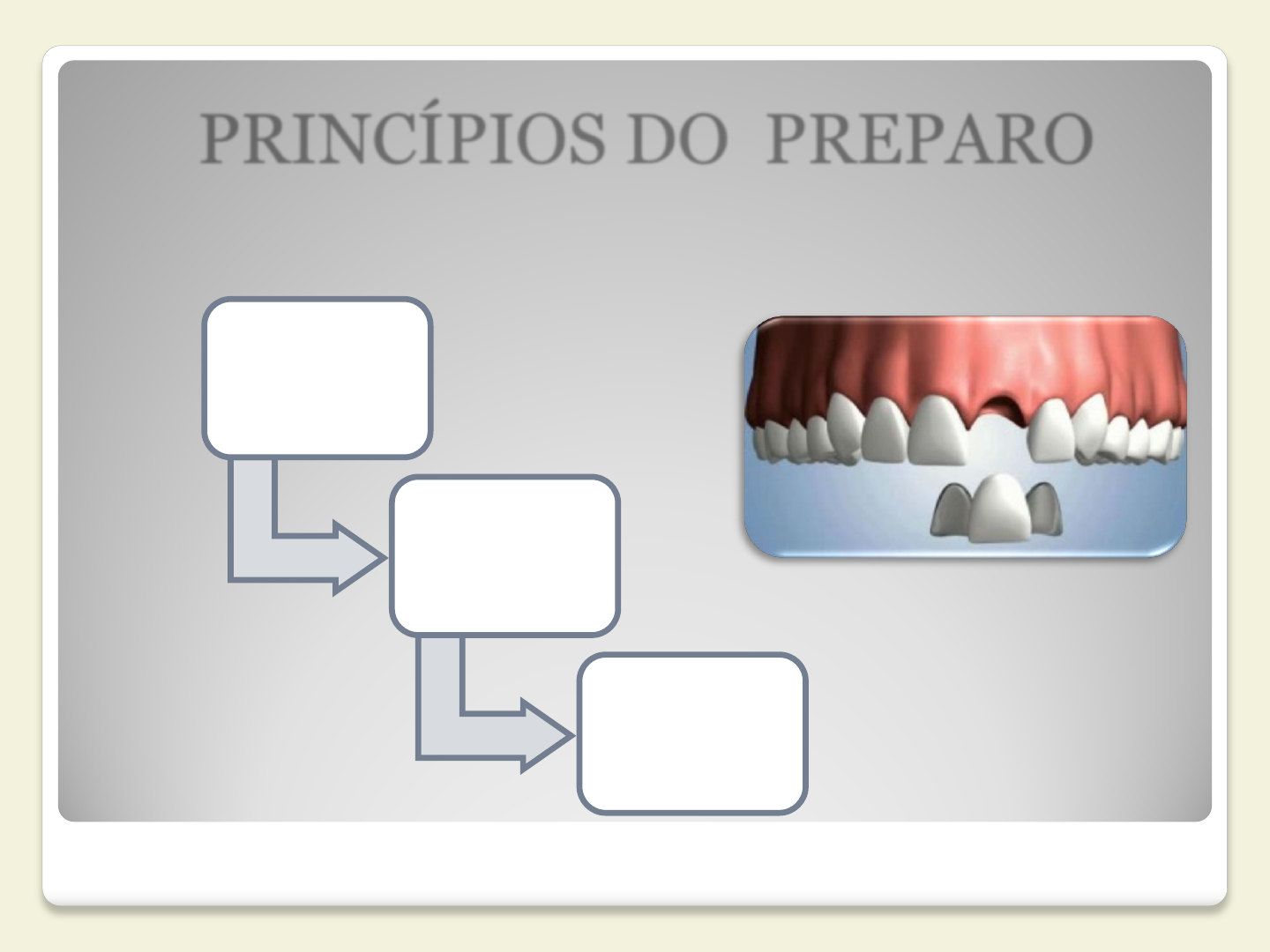 PREPARO PARA COROA METALOCERÂMICA EM DENTES ANTERIORES - Prótese Fixa