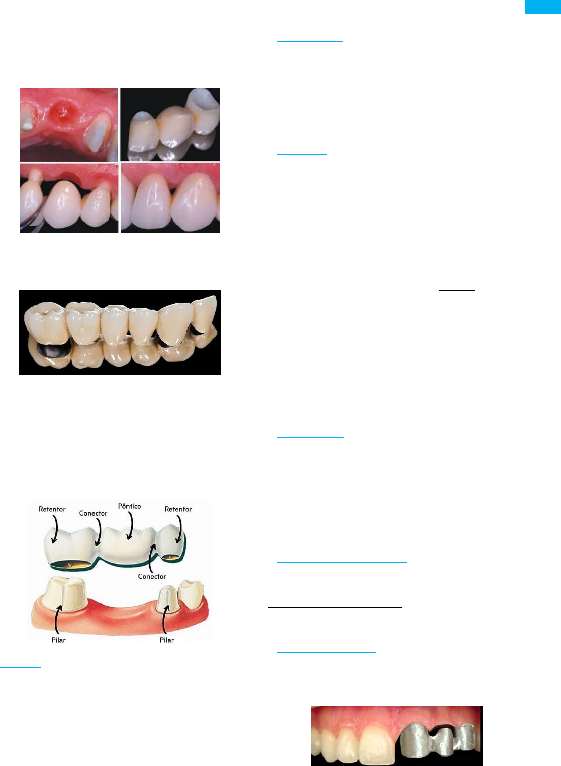 PRÓTESE FIXA - Introdução à prótese - Prótese Fixa