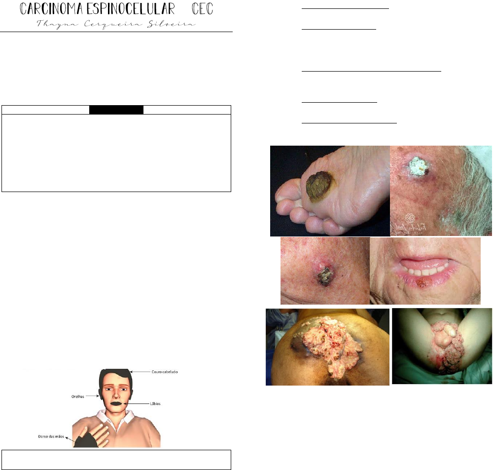 Histologia Do Carcinoma Verrucoso Invasive Squamous Carcinoma