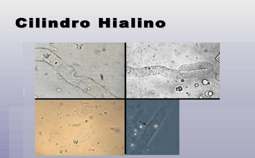 Cilindros Hialinos Na Urina Artefactos Urinários – Atlas De