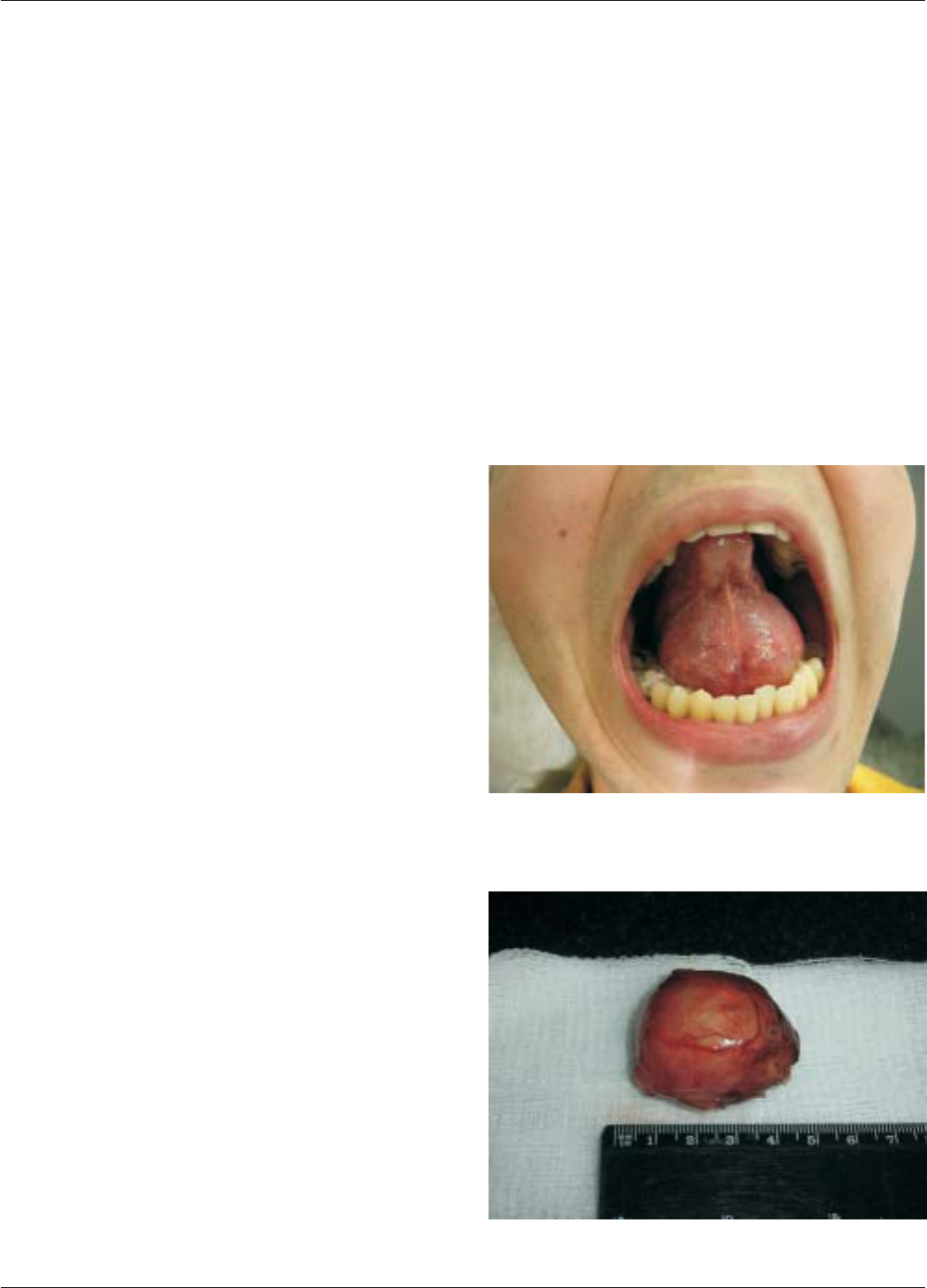 CISTO DERMOIDE - Patologia Oral e Maxilofacial