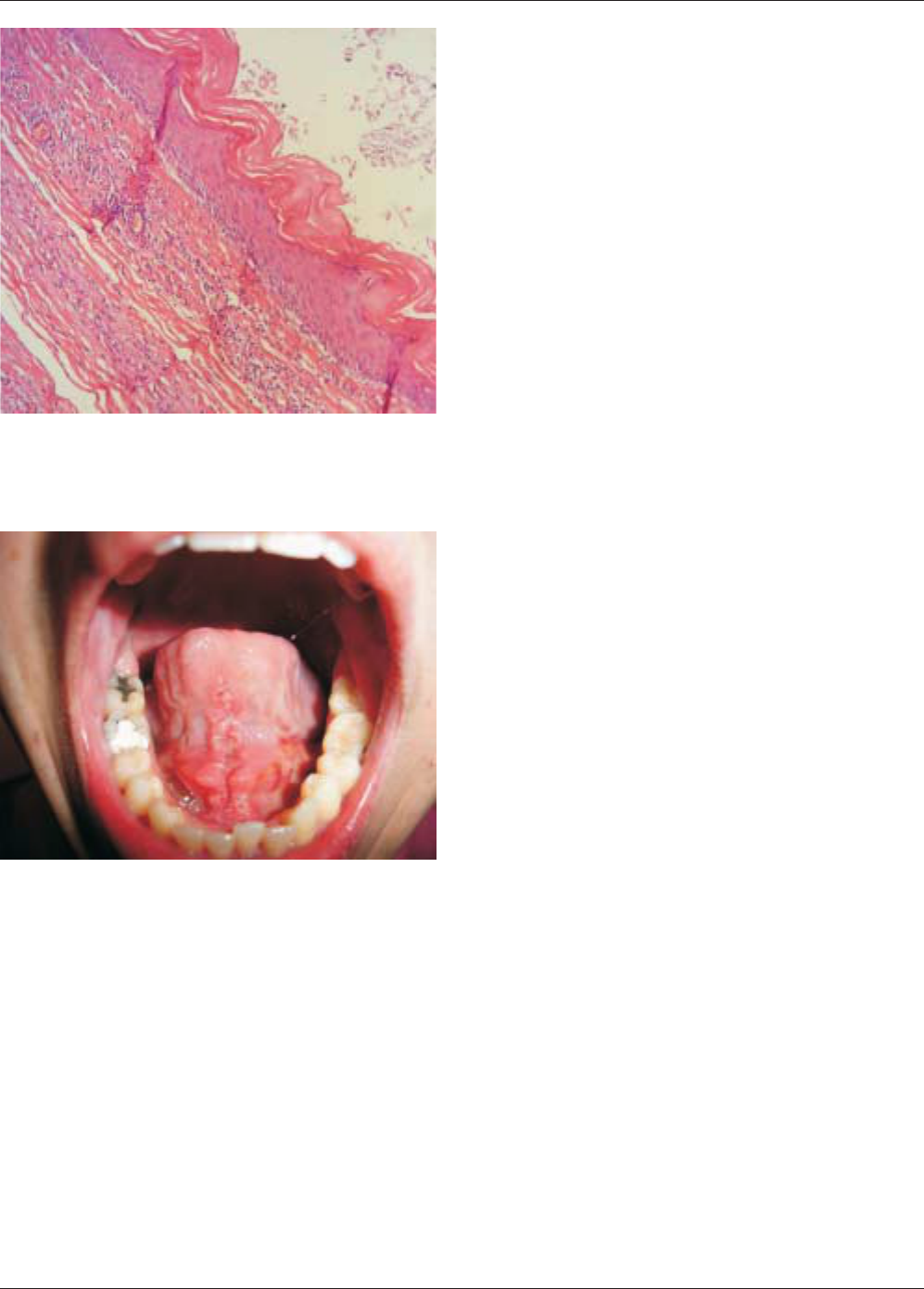 CISTO DERMOIDE - Patologia Oral e Maxilofacial