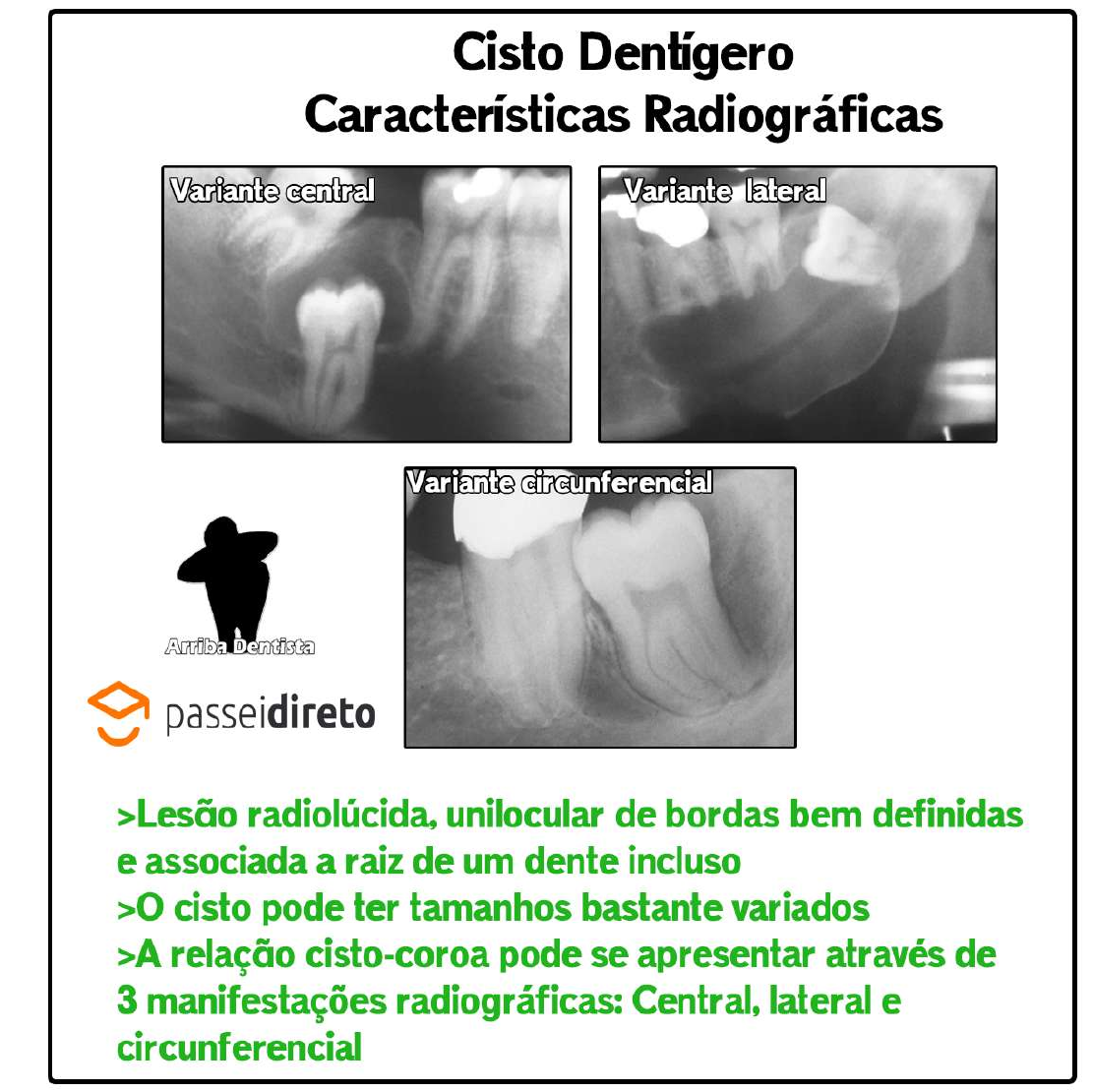 Patogenese Do Cisto Dentigero Aula De Cistos Uninove 2009 2003