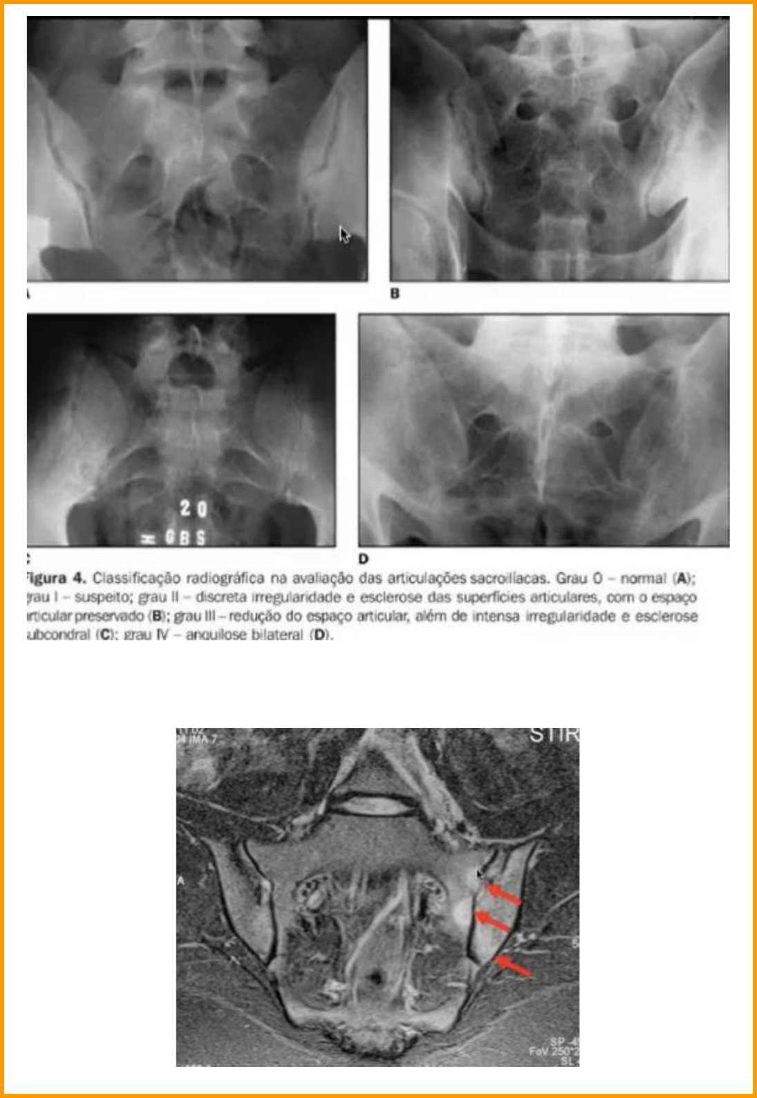 Ressonancia Magnetica De Espondilite Anquilosante Ankylosing