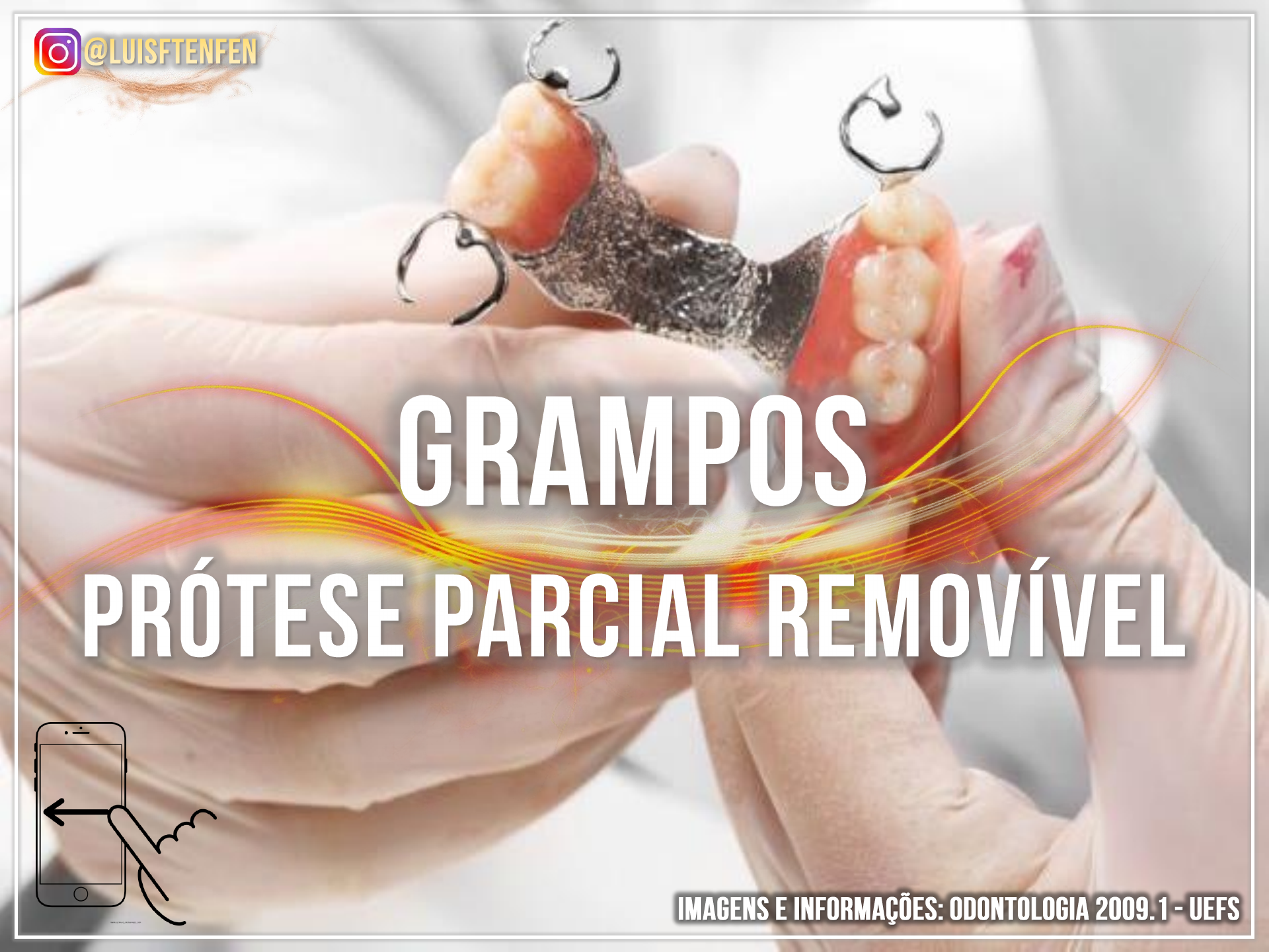 Grampos de PPR - Odontologia Morfofuncional do Ecossistema Bucal