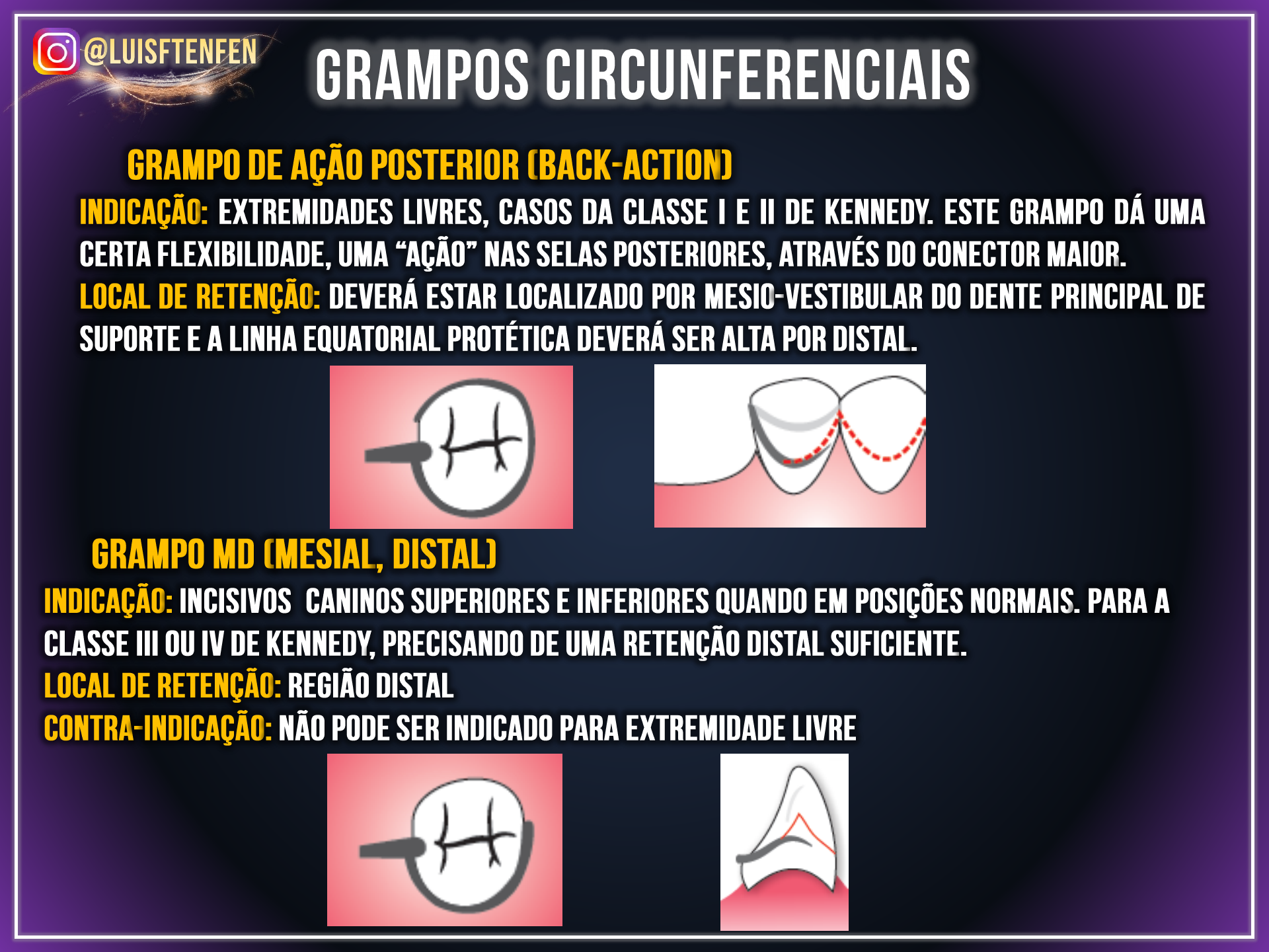 Grampos de PPR - Odontologia Morfofuncional do Ecossistema Bucal