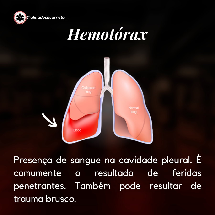 Hemotórax - Educação em Enfermagem